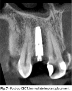 Partial Extraction Technique | Implant Evolution