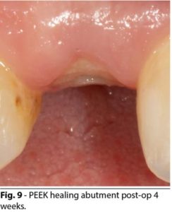 Partial Extraction Technique | Implant Evolution