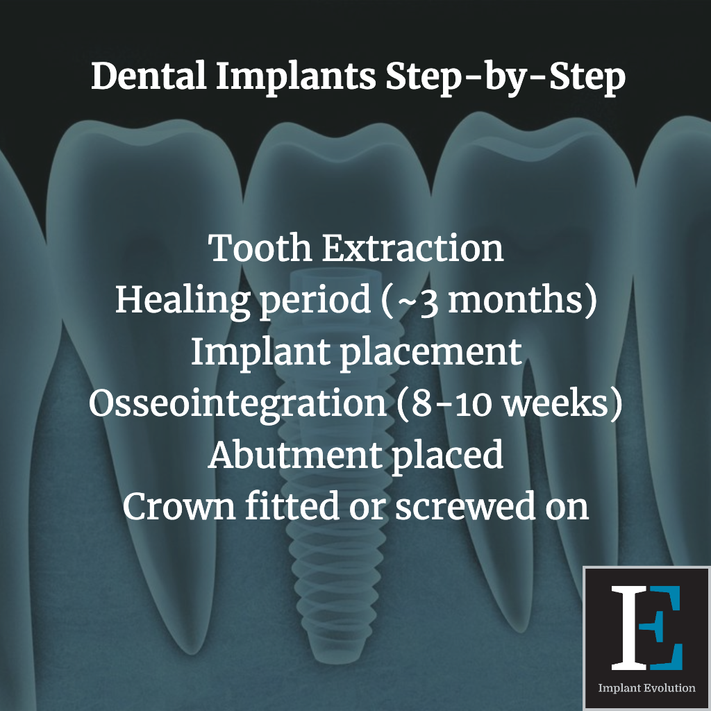 How long does it take for dental implants? | Implant Evolution